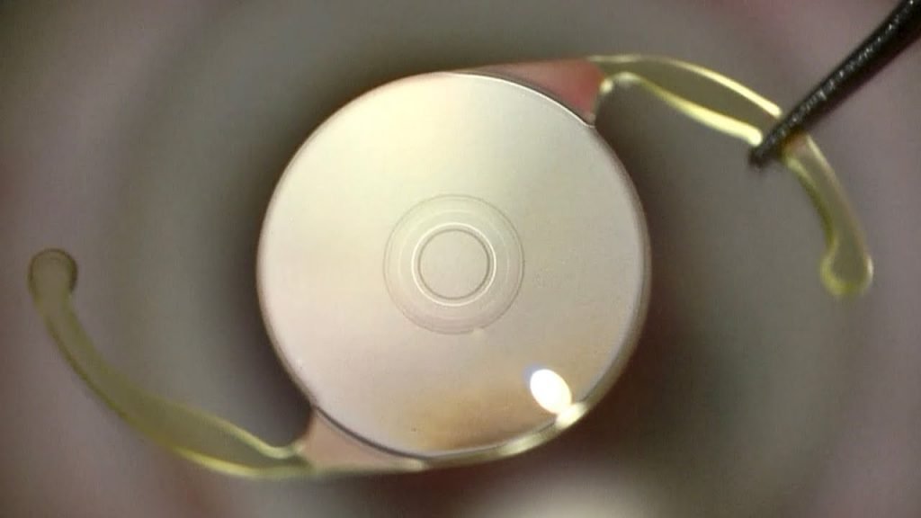 The Vivity ™ Extended Vision Intraocular Lens (IOL) | Op. Dr. Ferşat ...